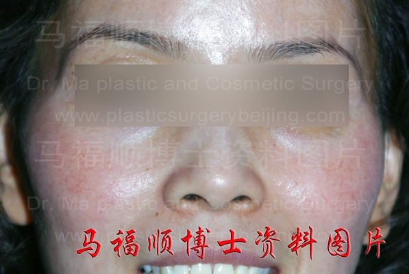 Photos of High Zygoma and Zygomatic Arch - DR. MA PLASTIC ...