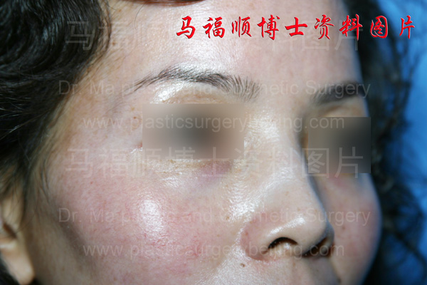 Photos of High Zygoma and Zygomatic Arch - DR. MA PLASTIC ...