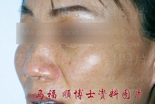 Photos of High Zygoma and Zygomatic Arch - DR. MA PLASTIC ...