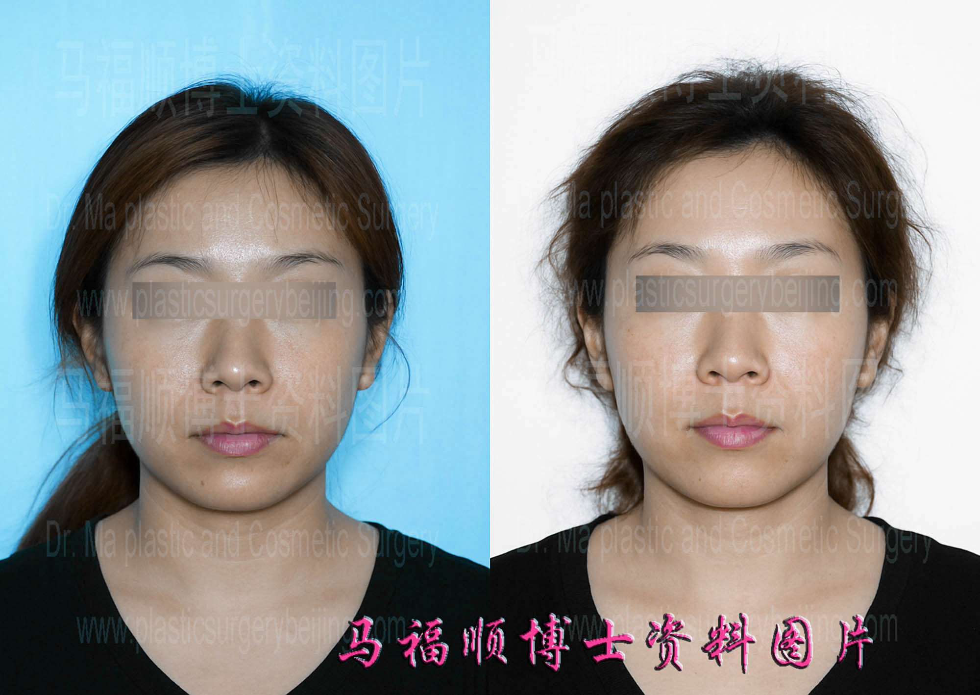 Bimaxillary Setback Surgery for Functional Improvement and making the ...