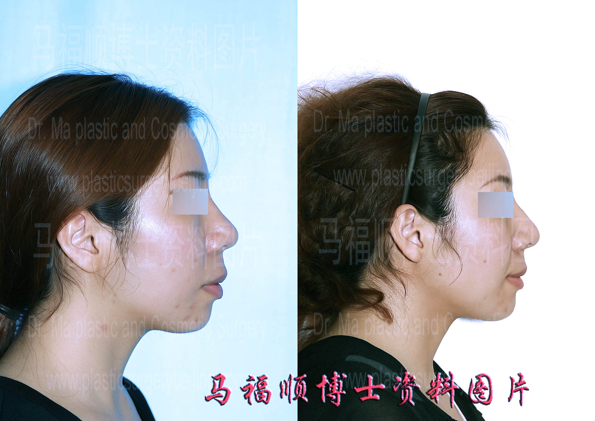 Bimaxillary Setback Surgery for Functional Improvement and making the ...