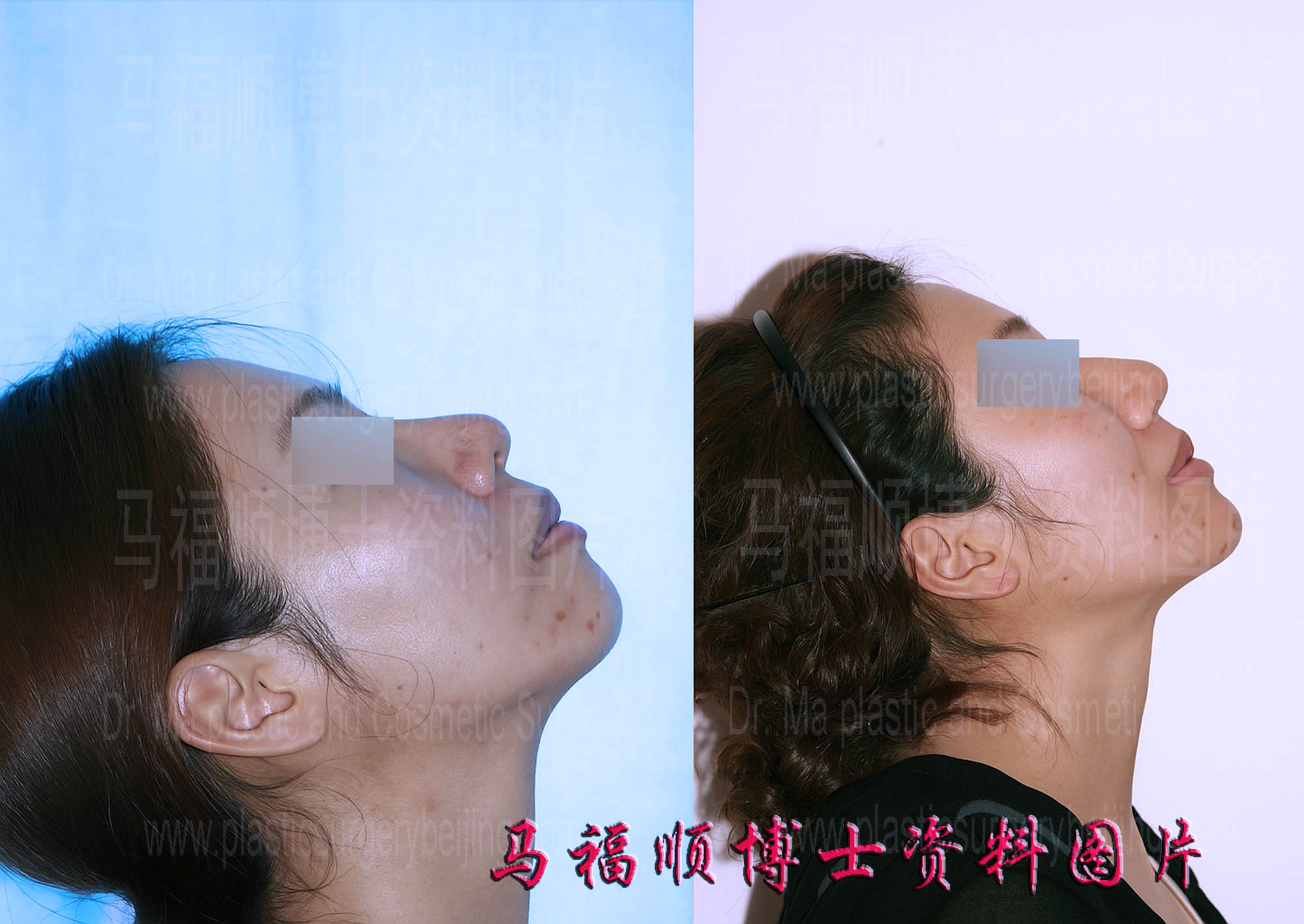 Bimaxillary Setback Surgery for Functional Improvement and making the ...