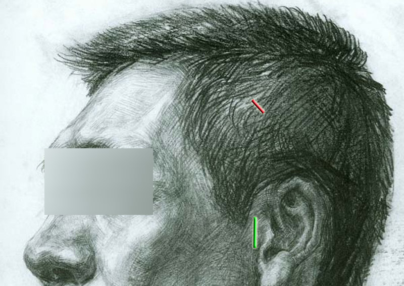 The Location and Mark of the Scalp Incision of Zygoma Bone and ...